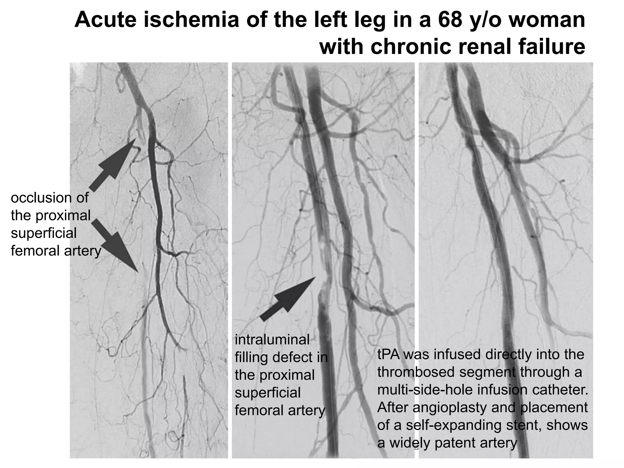 Acute Limb Ischemia | PDF