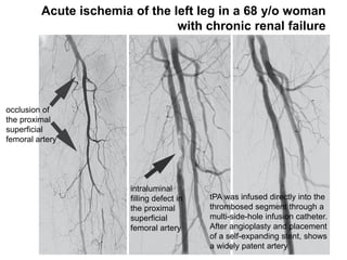 Acute Limb Ischemia | PDF