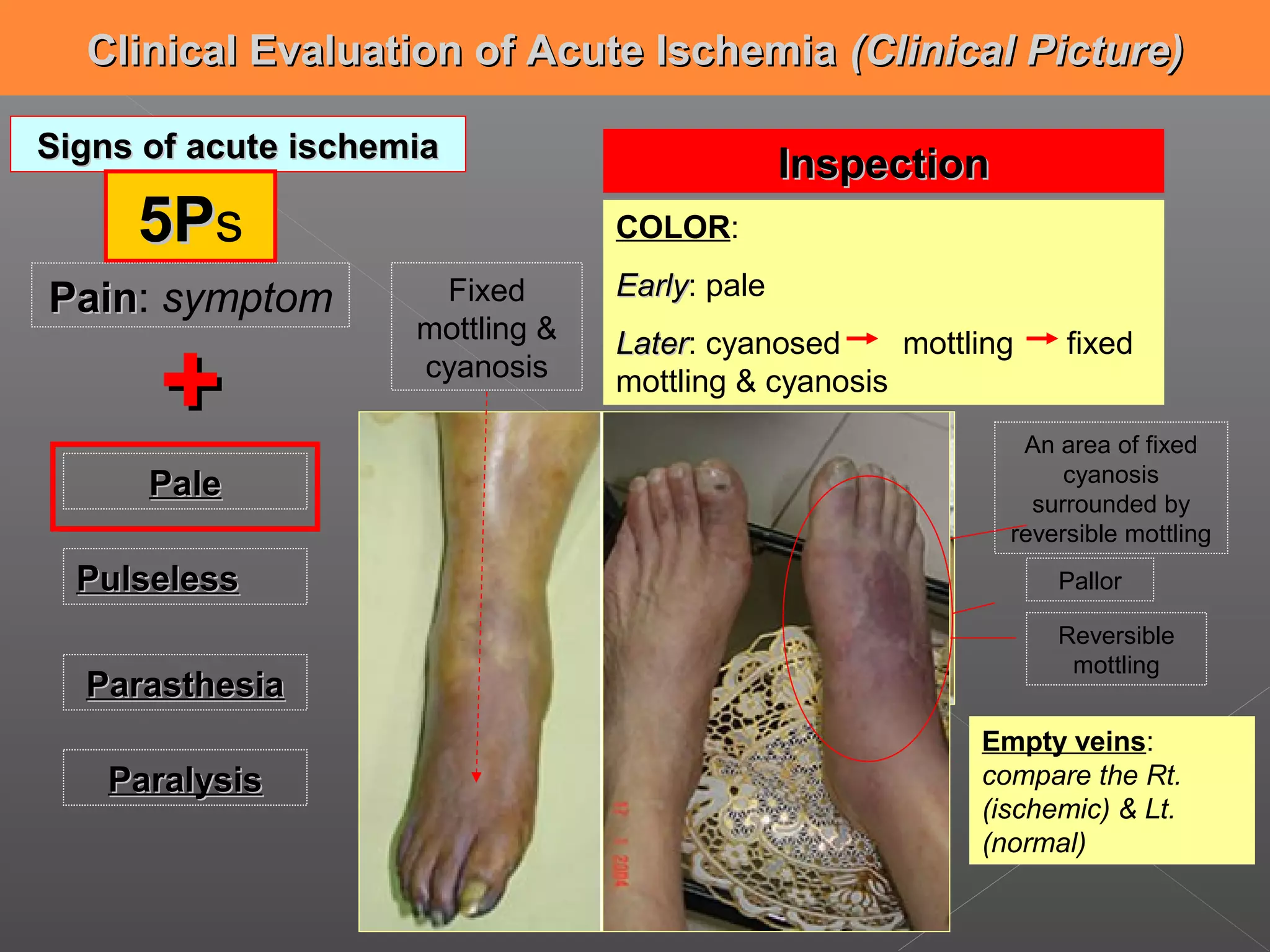 Acute limb ischemia | PPT