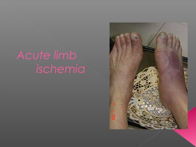 Acute limb ischemia