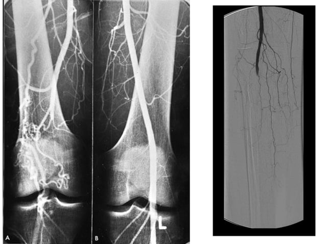 Acute limb ischemia