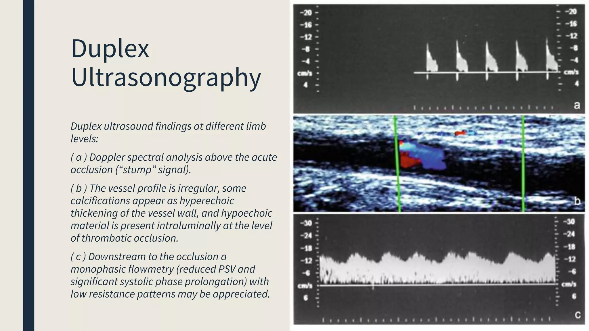 Acute limb ischemia | PPTX