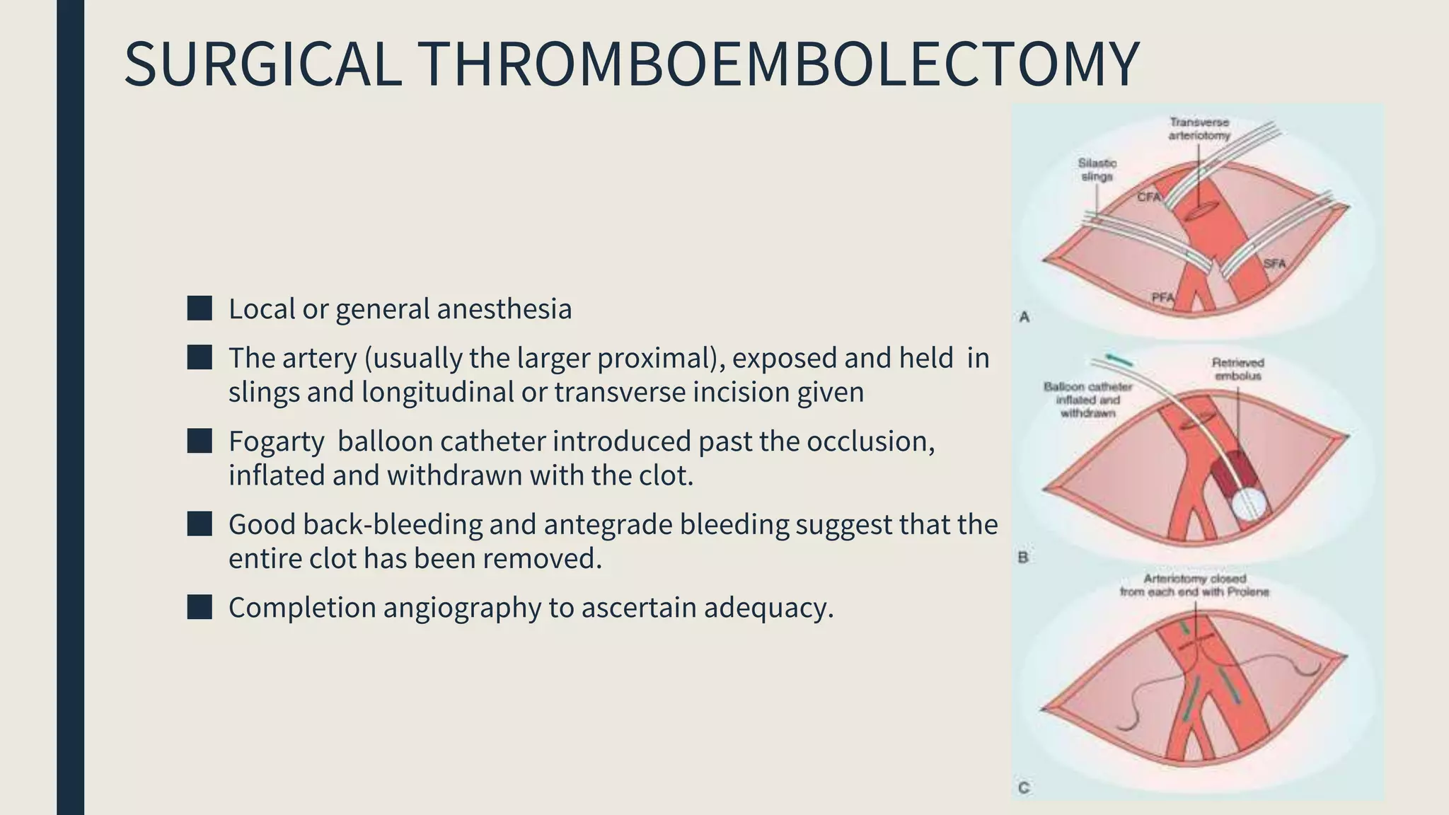 Acute limb ischemia | PPTX