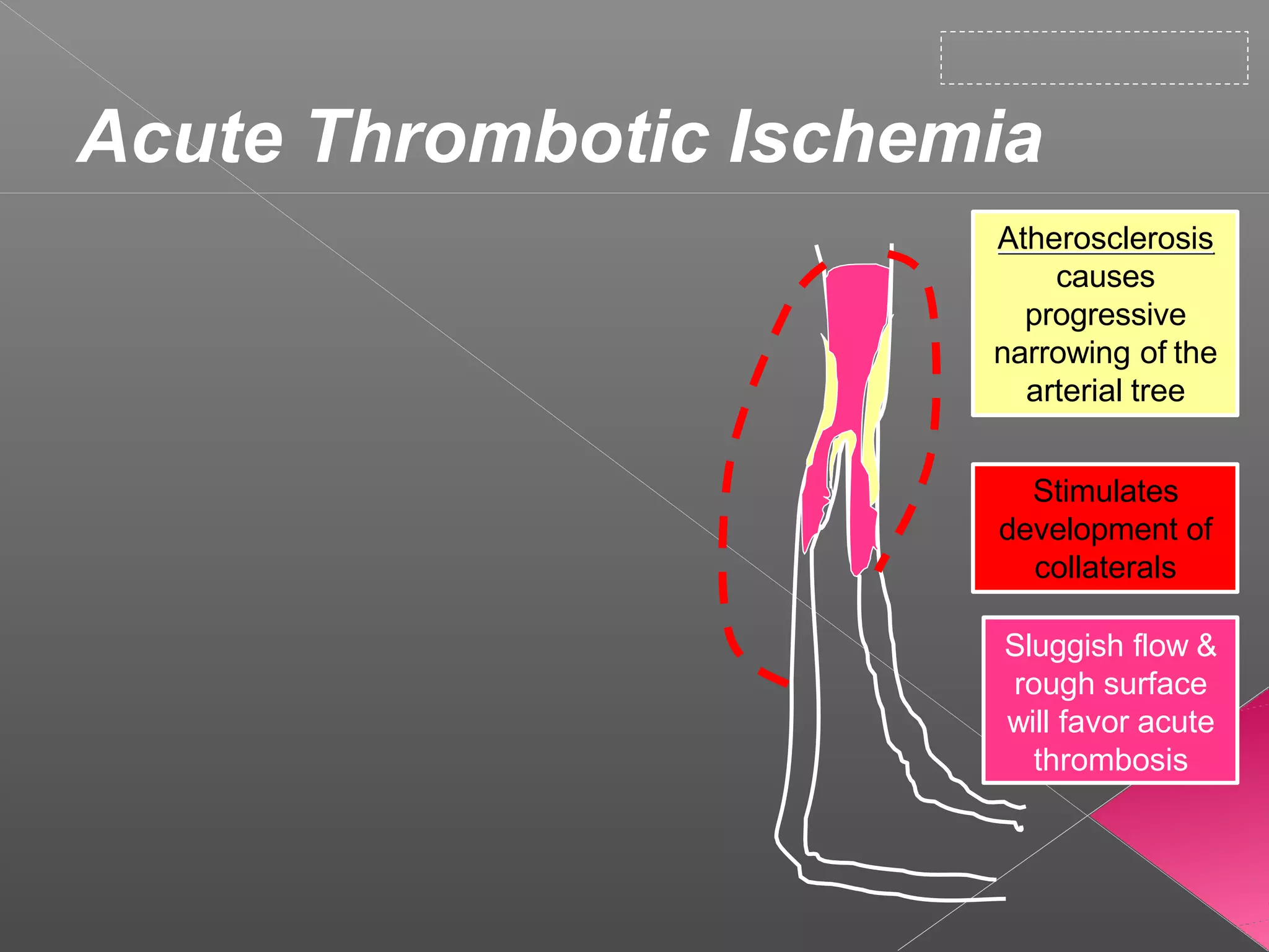 Acute limb ischemia | PPTX