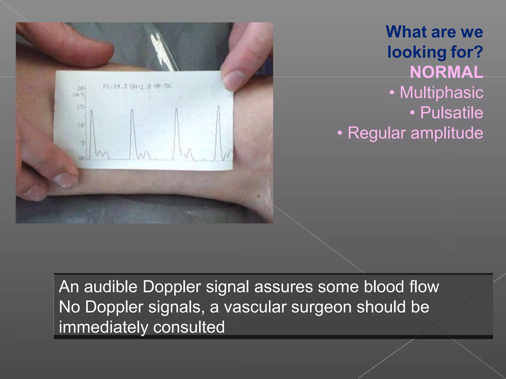 Acute limb ischemia | PPTX