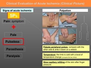 Acute limb ischemia | PPTX
