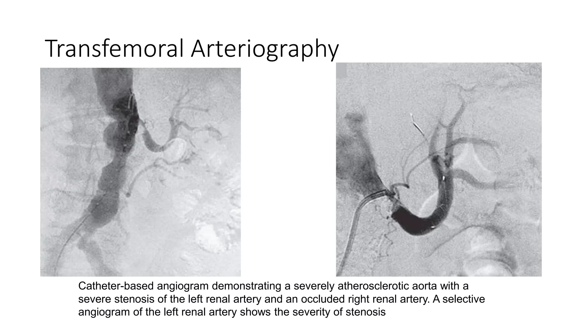 Acute limb ischemia | PPTX