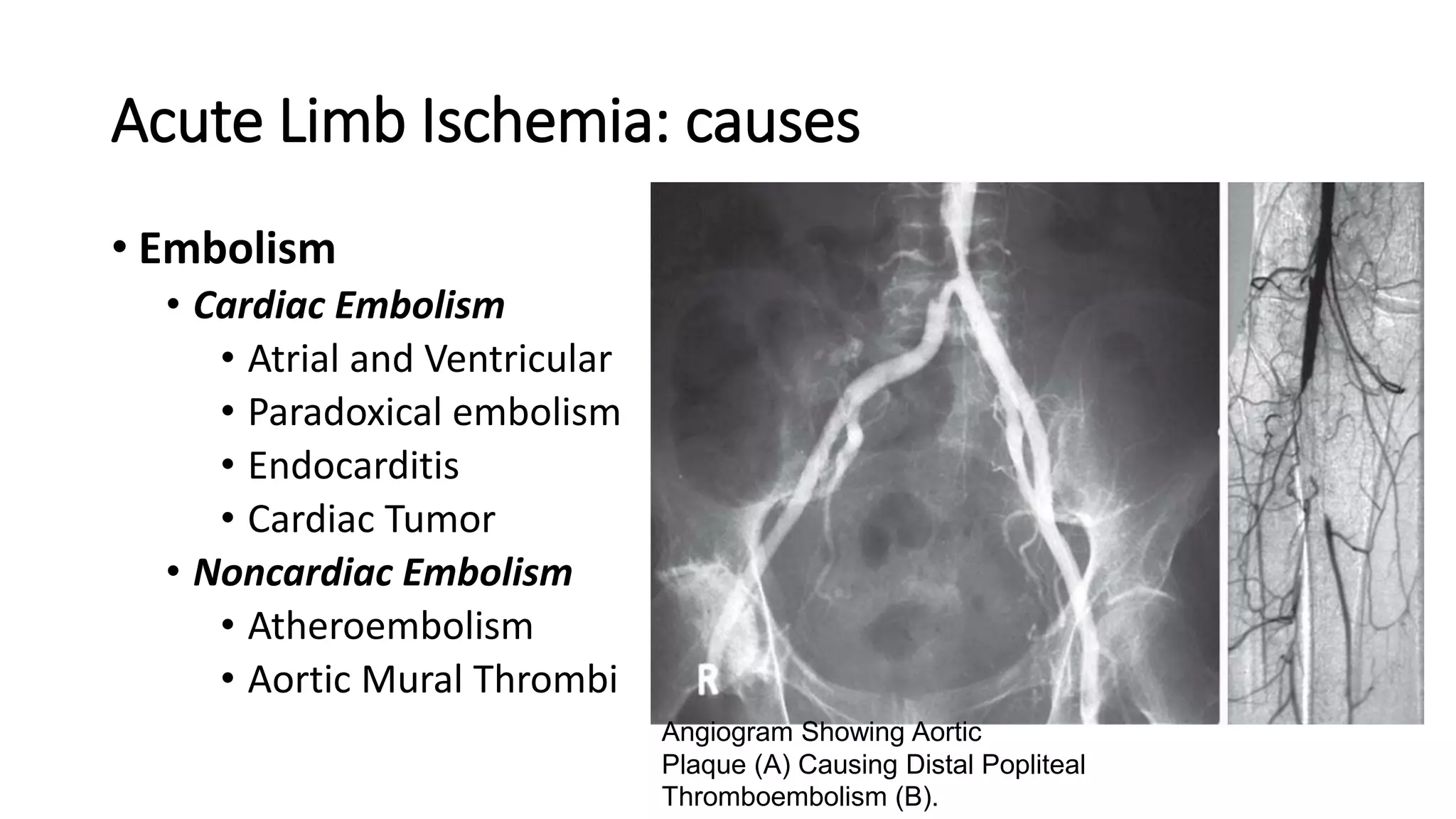 Acute limb ischemia | PPTX