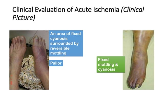 Acute limb ischemia | PPTX