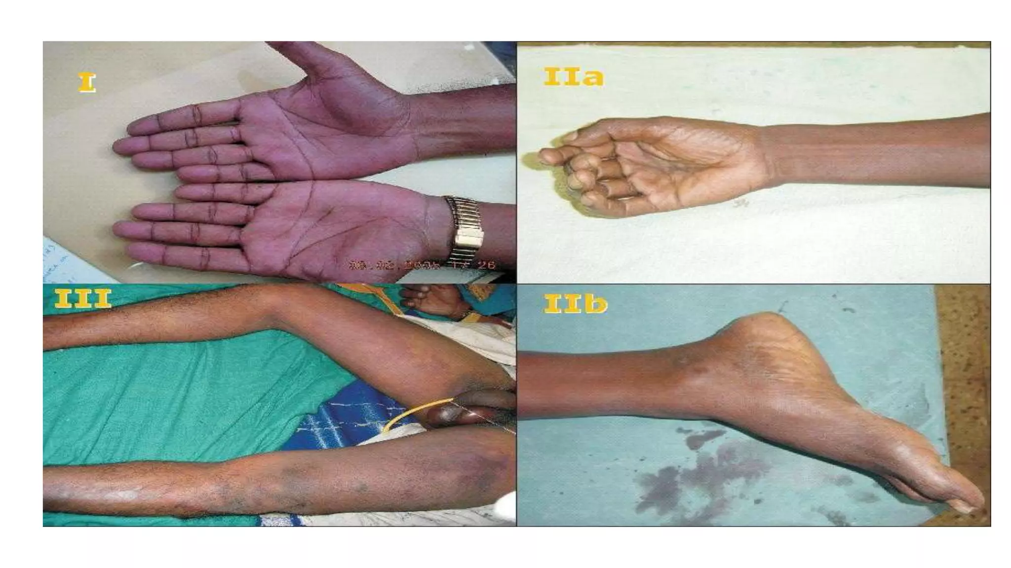 Acute limb ischemia | PPTX