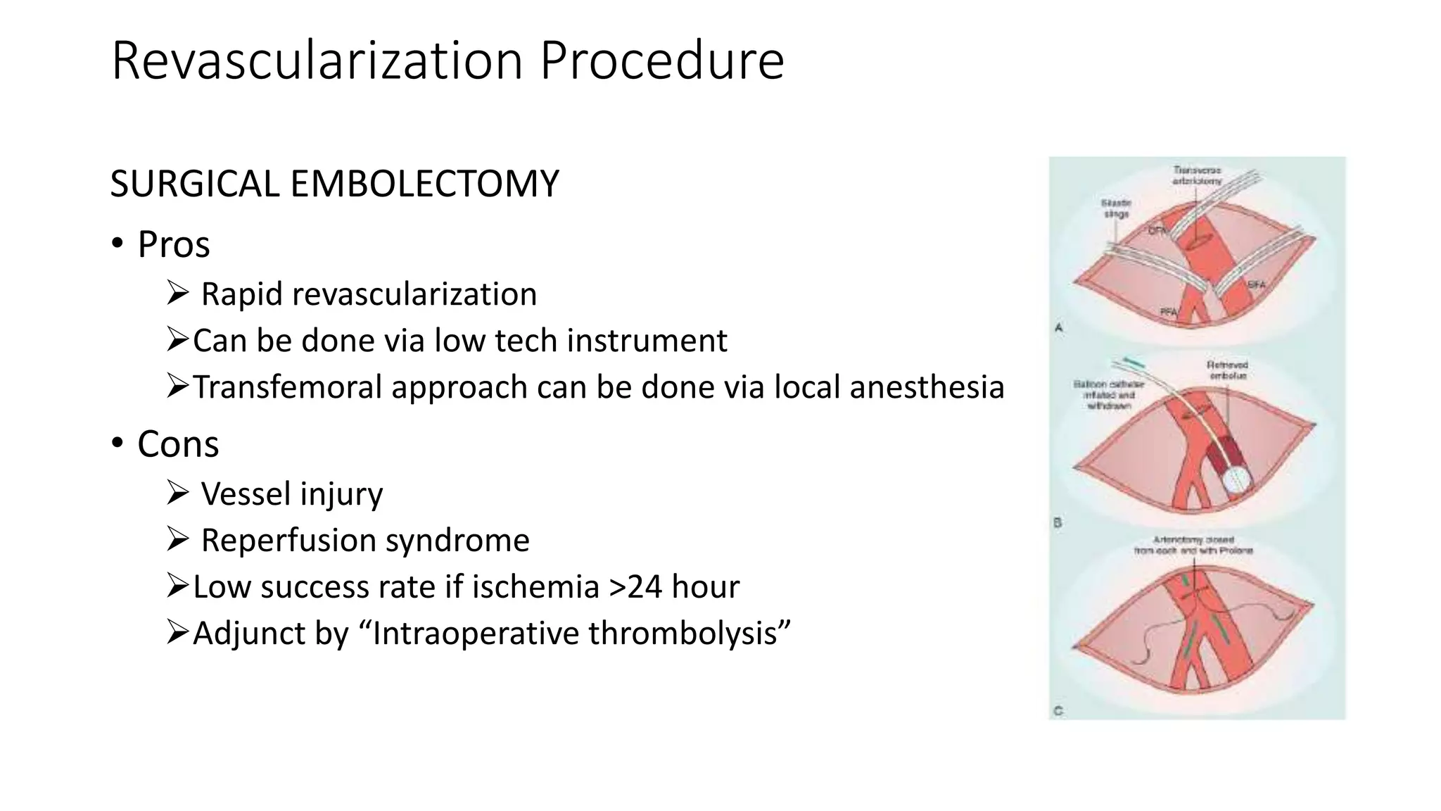 Acute limb ischemia | PPTX