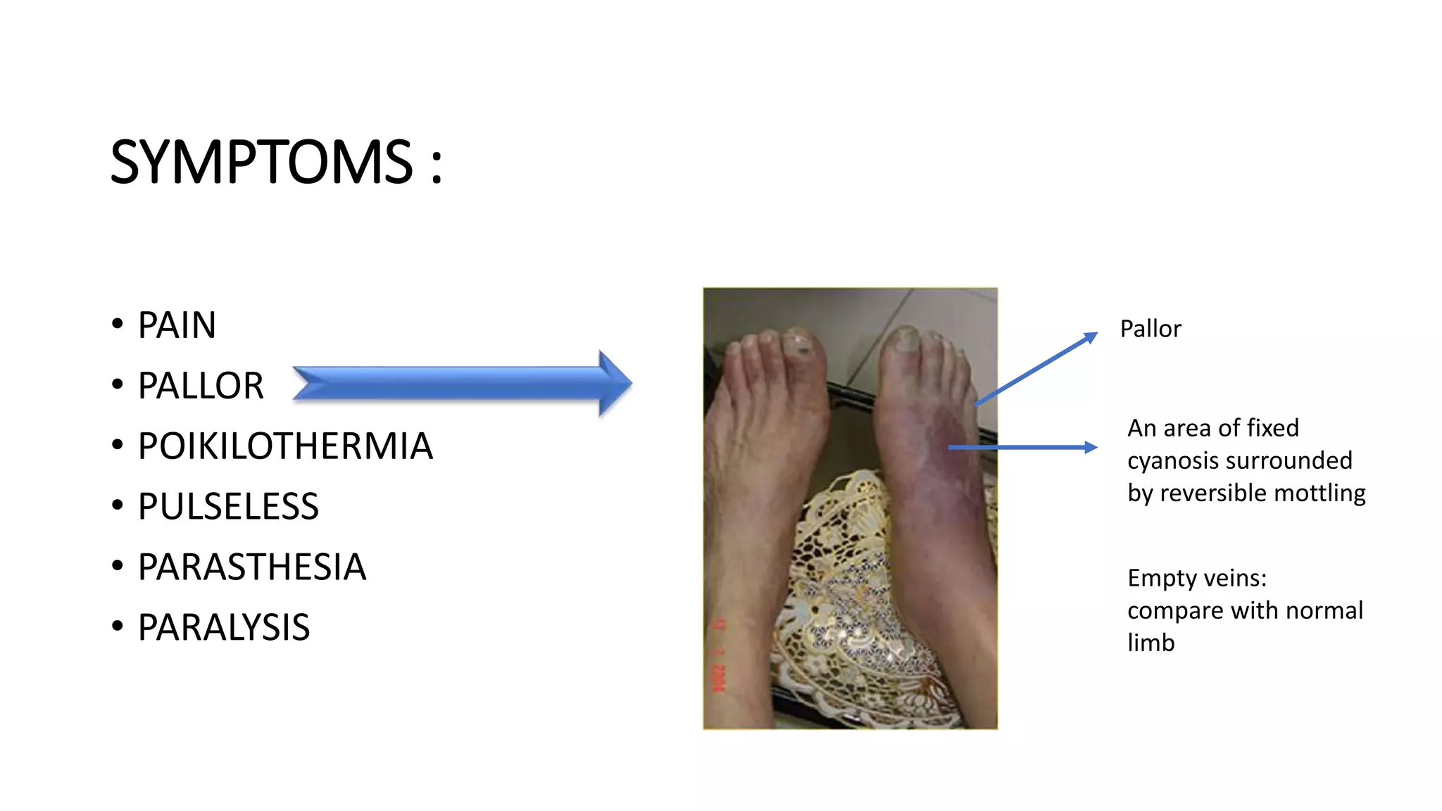 Acute limb ischemia | PPTX