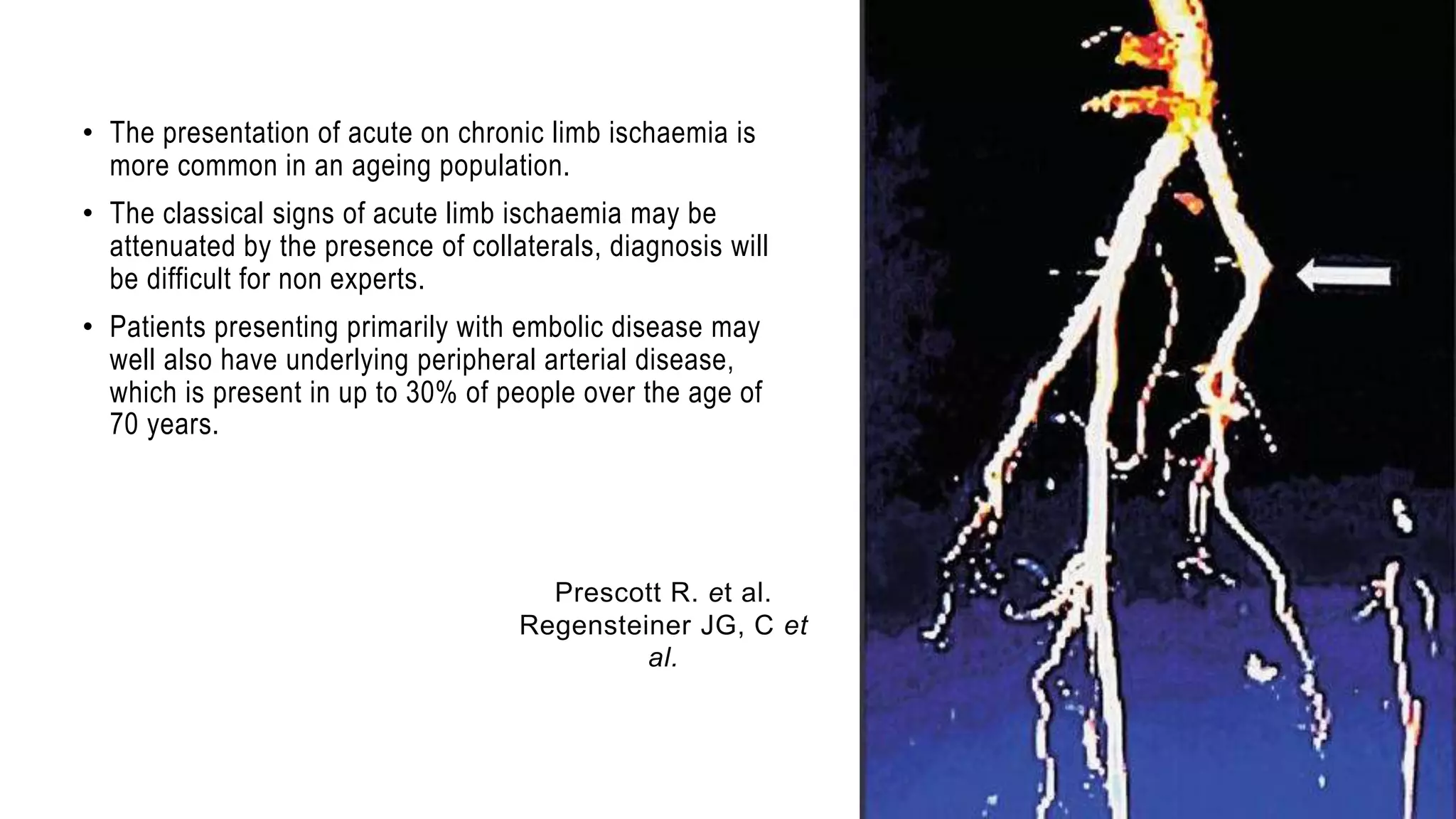 Acute Limb Ischemia | PPSX