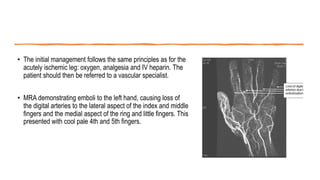 Acute Limb Ischemia | PPSX