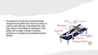 Acute Limb Ischemia | PPSX