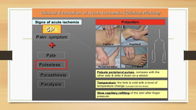 Slide of Acute limb ischemia (diagnosis, complication, management) | PPTX