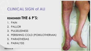 Acute Limb Ischemia and Role of DOAC.pptx