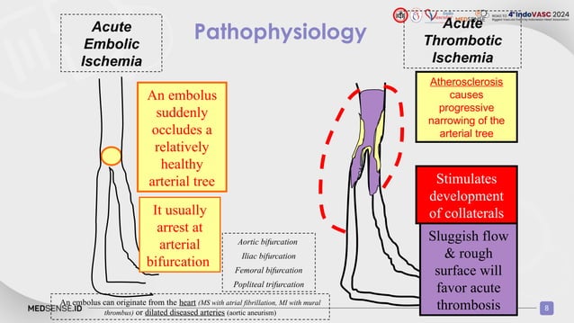 Acute Limb Ischemia and Role of DOAC.pptx