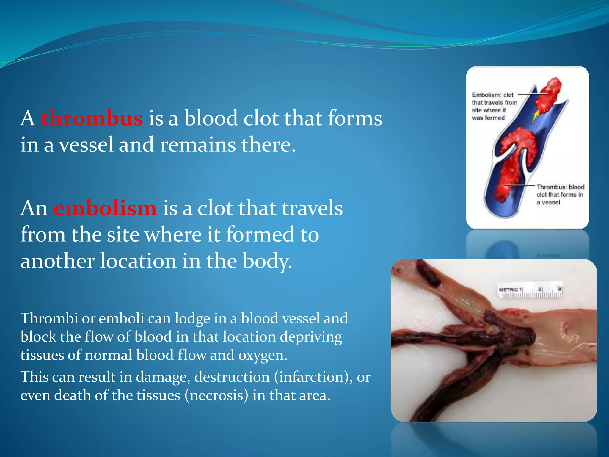 ACUTE LIMB ISCHEMIA SURGICAL management.pptx