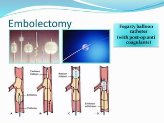 ACUTE LIMB ISCHEMIA SURGICAL management.pptx