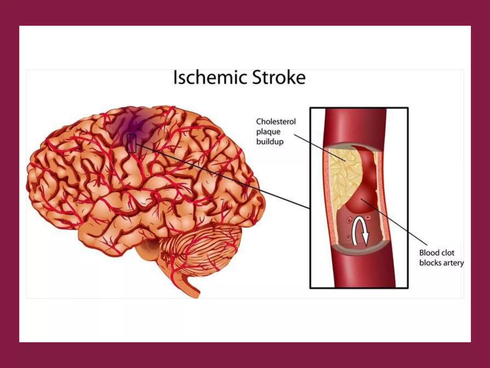 Acute Limb Weakness.pptx