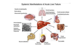 ACUTE LIVER FAILURE.pptx HEPATOBILIARY SYSTEM | PPT
