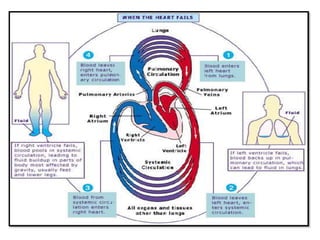Acute left ventricular failure secondary to Ischemic heart disease and ...