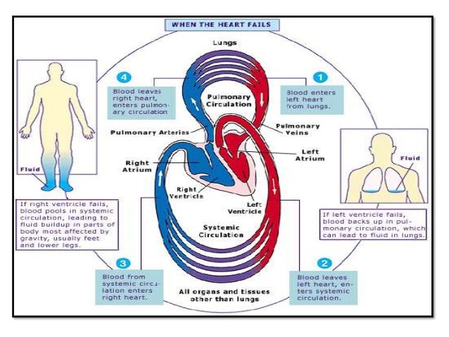 Acute left ventricular failure secondary to Ischemic heart disease a…