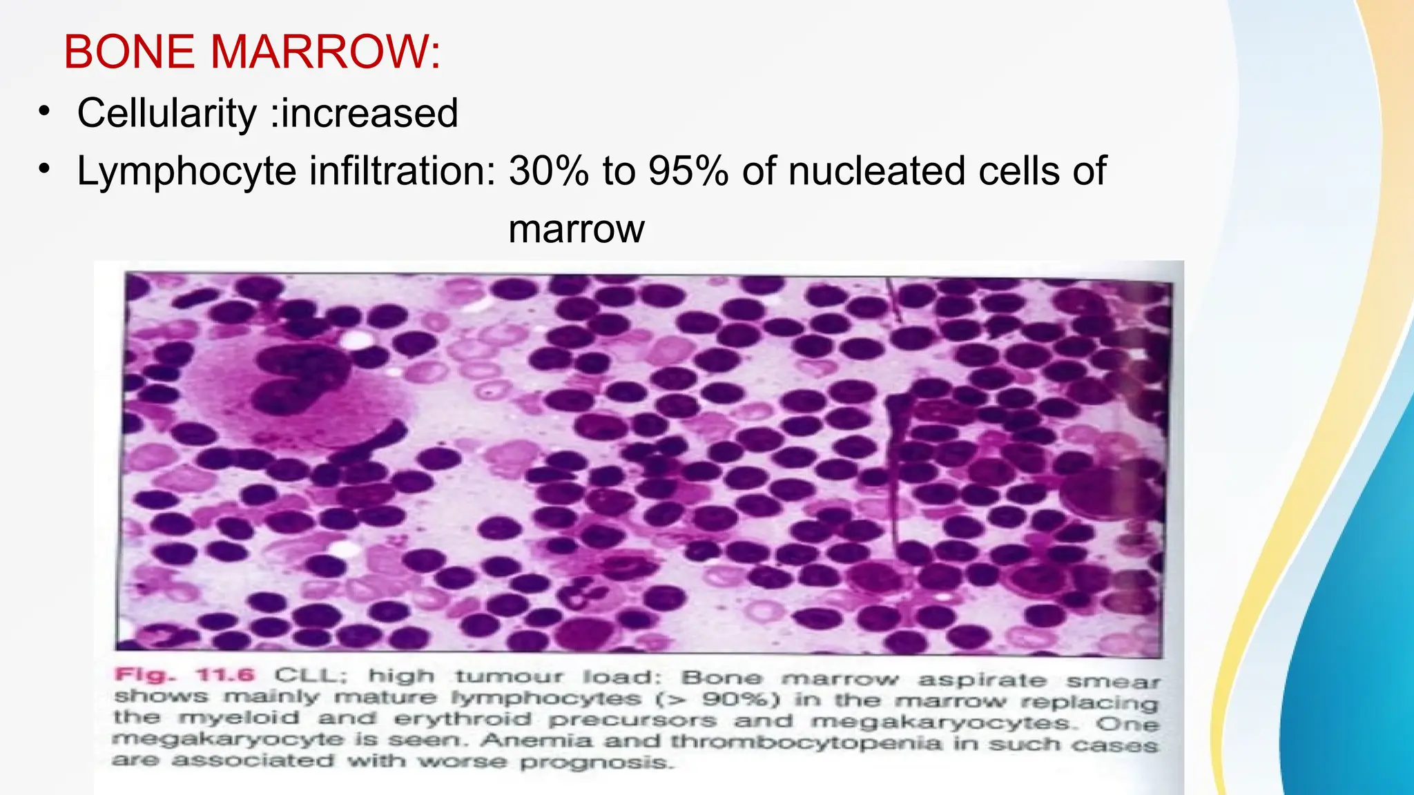 ACUTE and CHRONIC LYMPHOBLASTIC LEUKEMIA-1.pptx