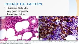ACUTE and CHRONIC LYMPHOBLASTIC LEUKEMIA-1.pptx