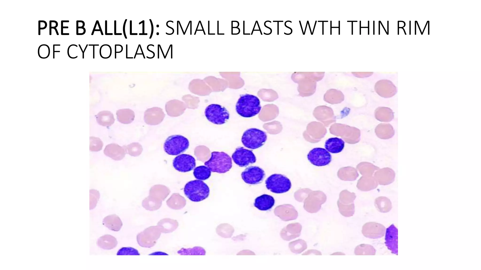 Acute lymphoblastic leukemia | PPTX