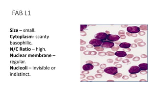 Acute lymphoblastic leukemia | PPTX