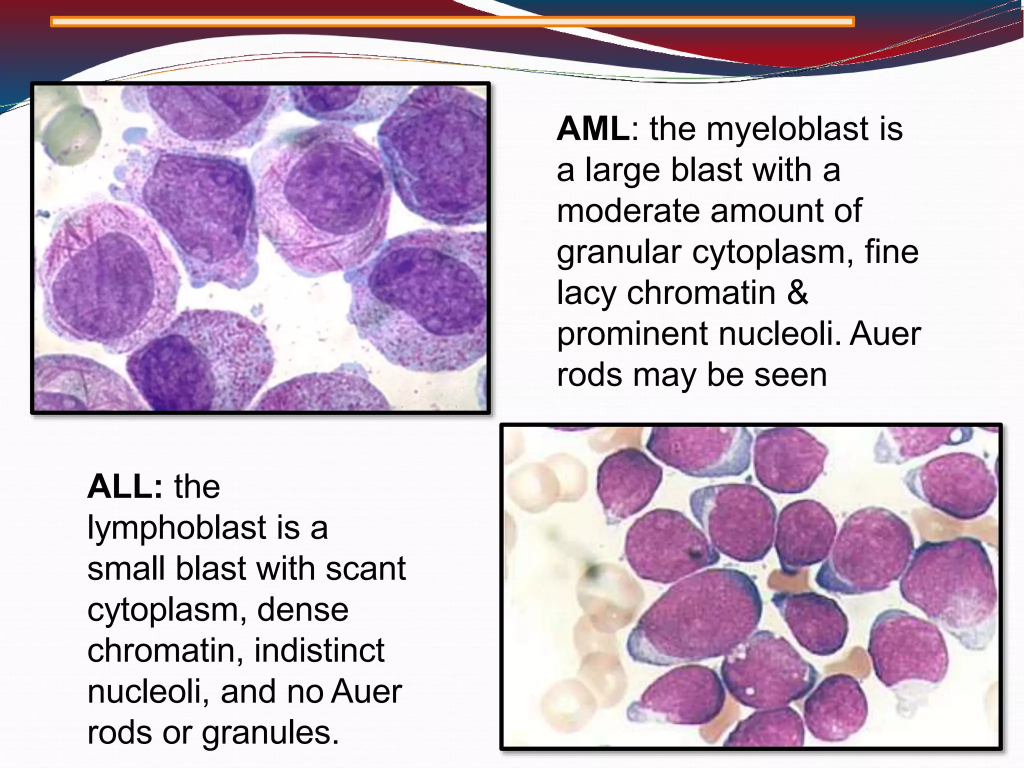 acute lymphoblastic leukemia.pptx