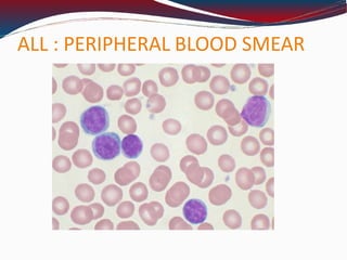 acute lymphoblastic leukemia.pptx