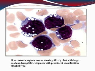 acute lymphoblastic leukemia.pptx