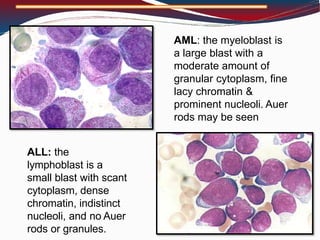 acute lymphoblastic leukemia.pptx