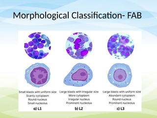 Acute Lymphoid Leukemia.pptx based on internal medicine | PPT