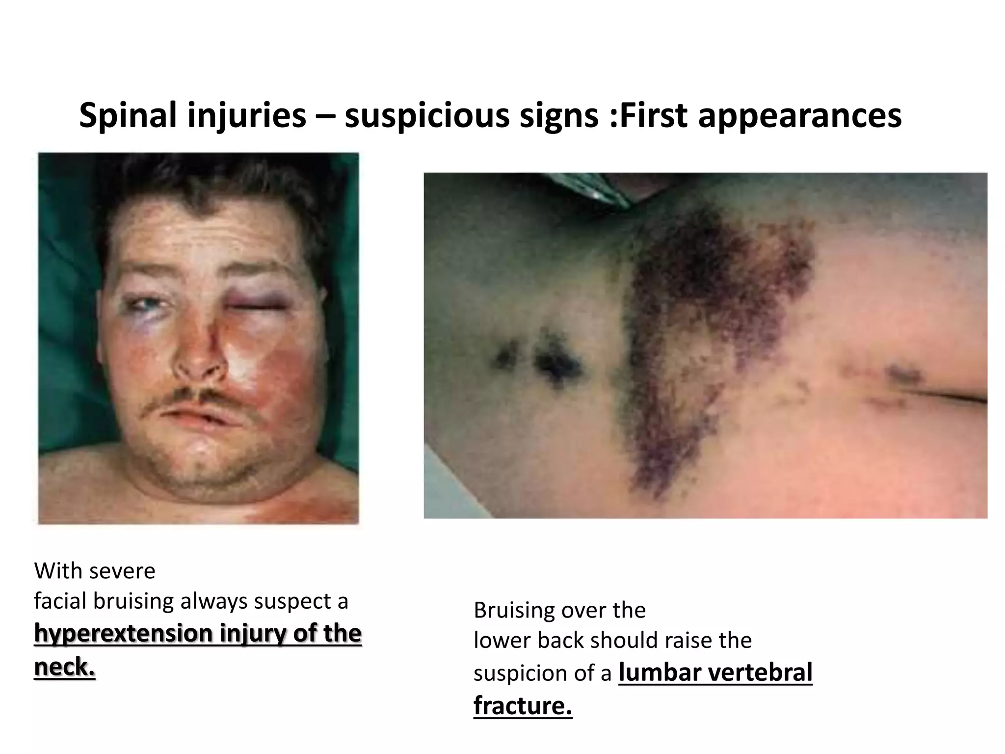 Acute management and decision making in spinal cord injury by dr ss ...