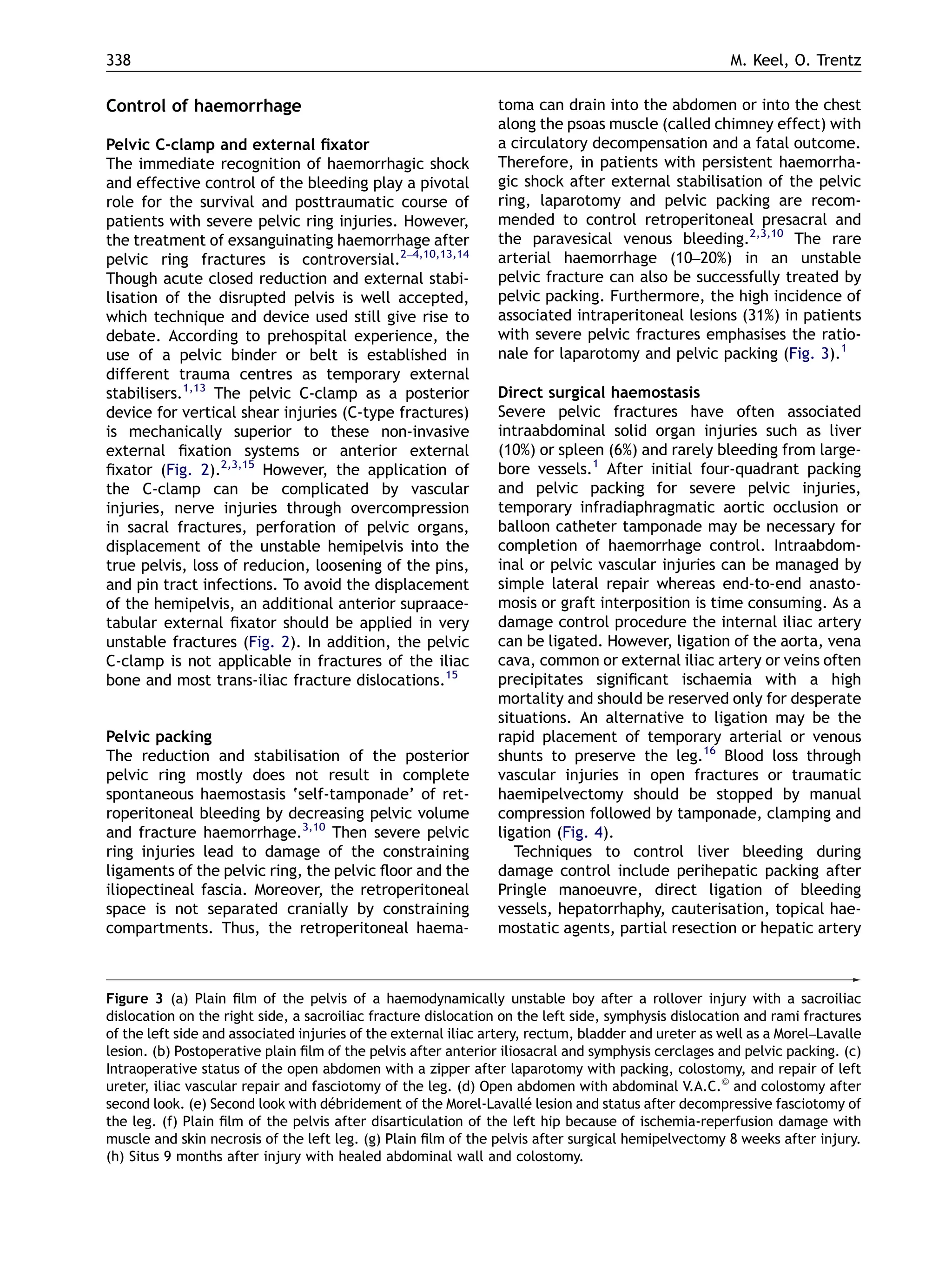 Acute Management Of Pelvic Ring Fractures.pdf
