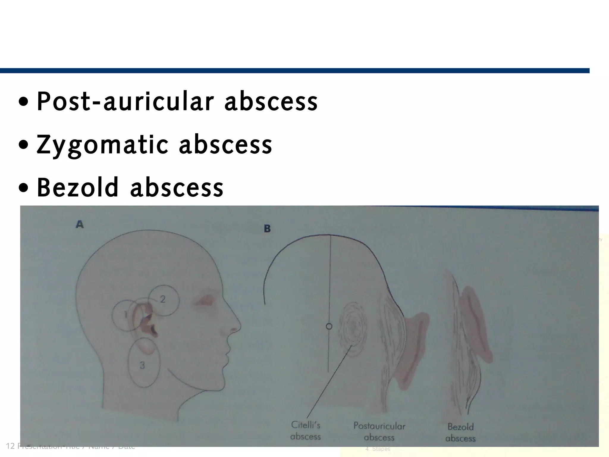 Acute mastoiditis lecture | PPT