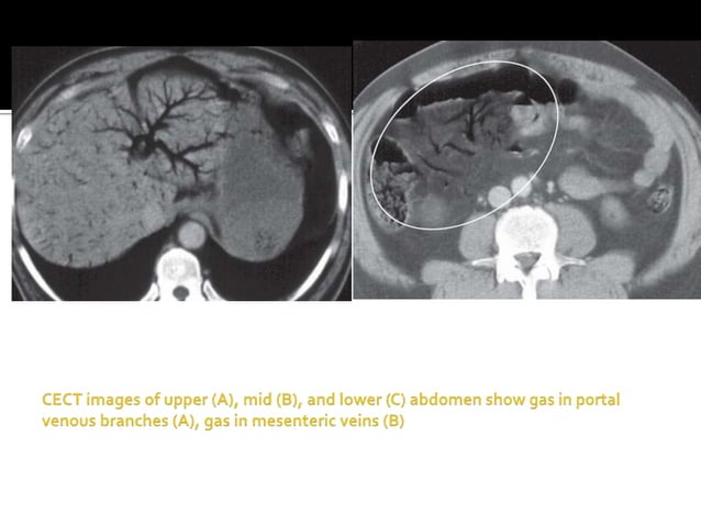 CT diagnosis of Acute mesenteric ischemia from various causes | PPT
