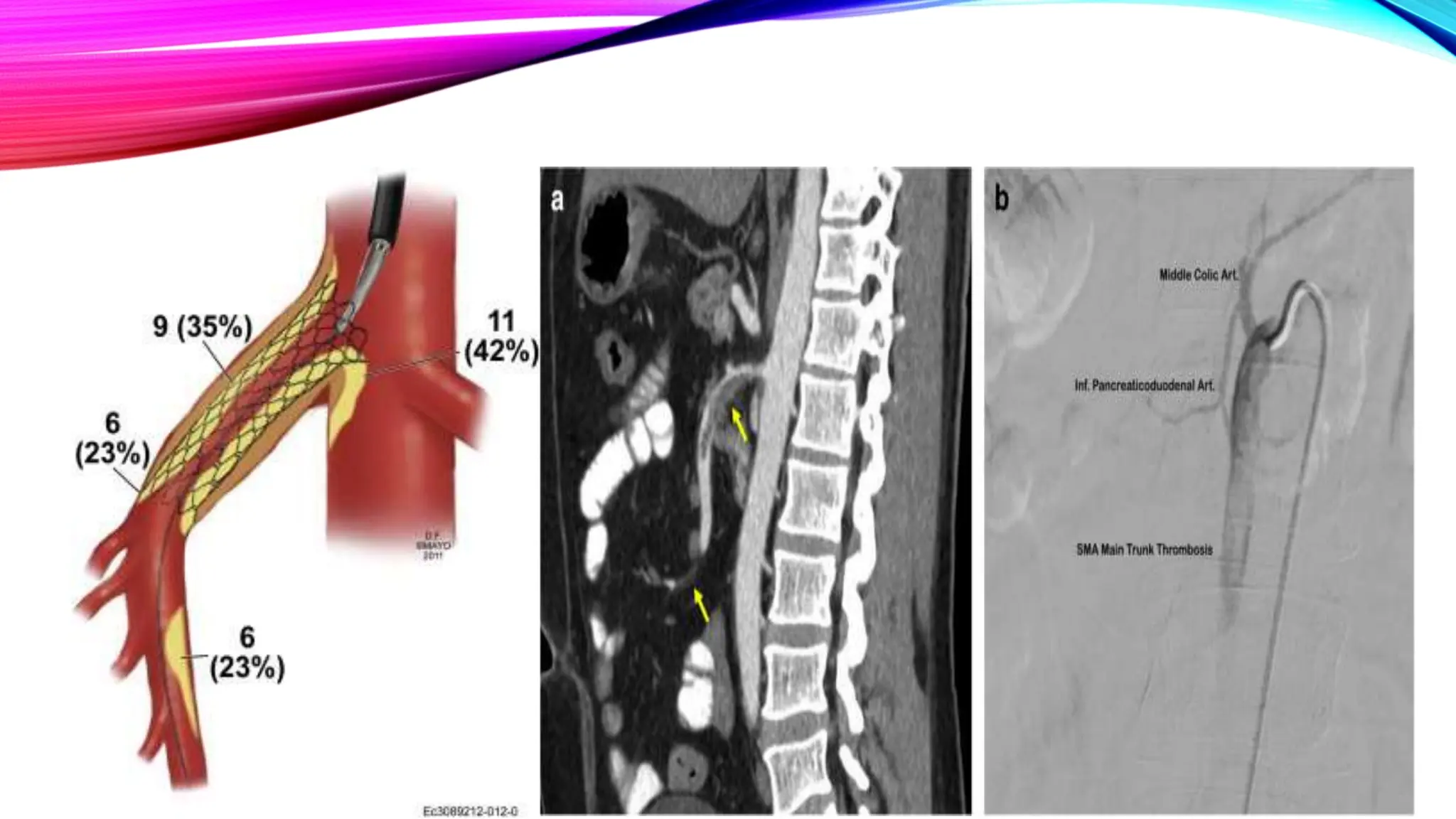 Acute mesenteric ischemia; anatomy, pathophysiology and management | PPTX