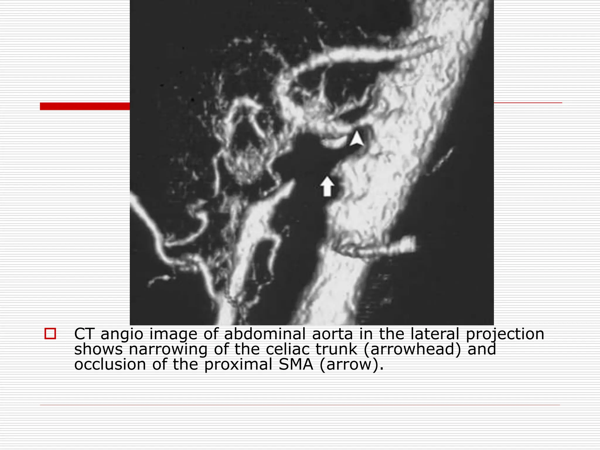 acute mesentric ischemia sanaa university .ppt