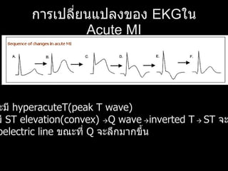 Acute Mi | PPT