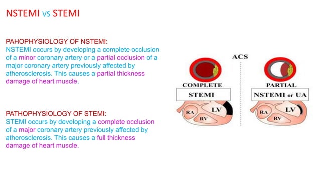 Acute MI - NSTEMI | PPTX