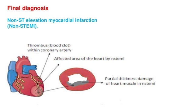 Acute MI - NSTEMI