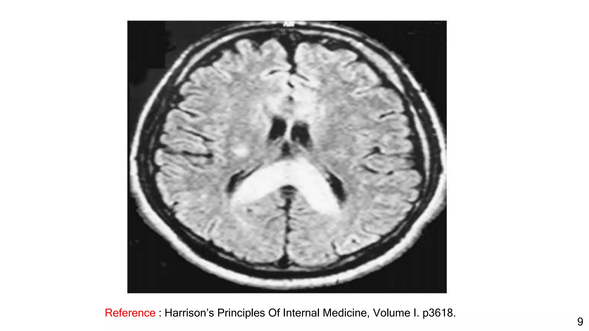 Acute Mountain Sickness and High-Altitude Cerebral Edema - Risk factors ...