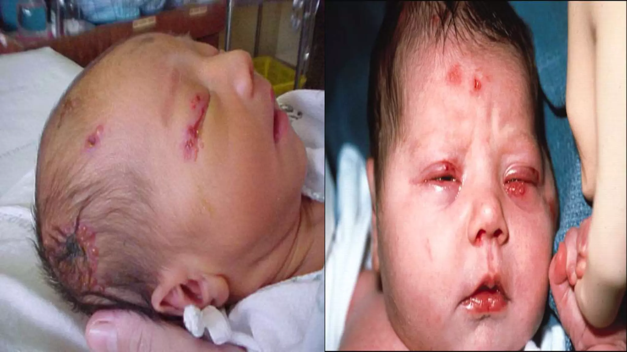 Acute multiple Oral ulcers | PPTX