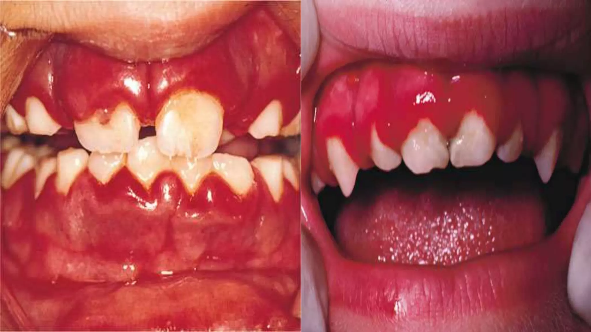 Acute multiple Oral ulcers | PPTX