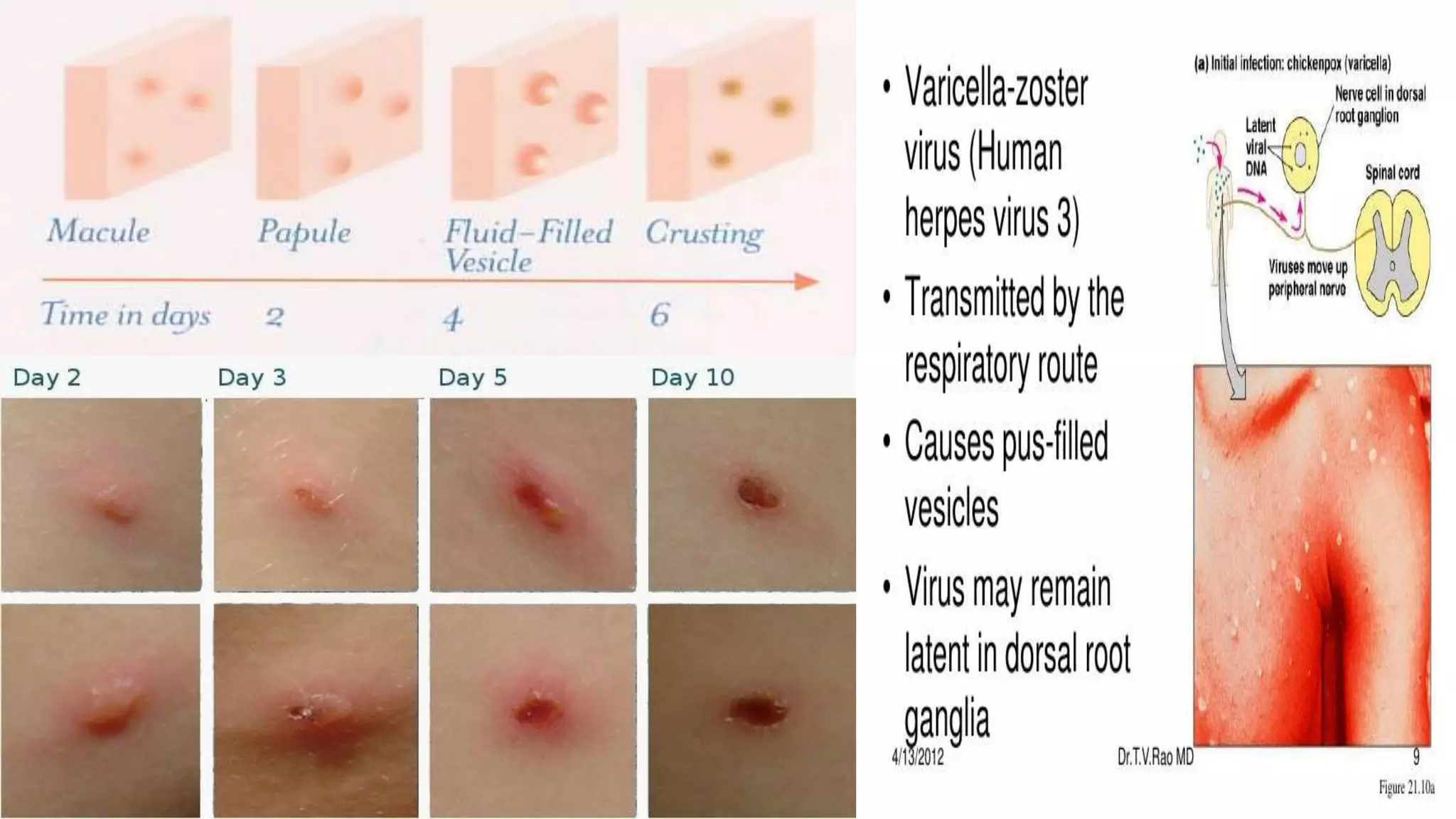 Acute multiple Oral ulcers | PPTX